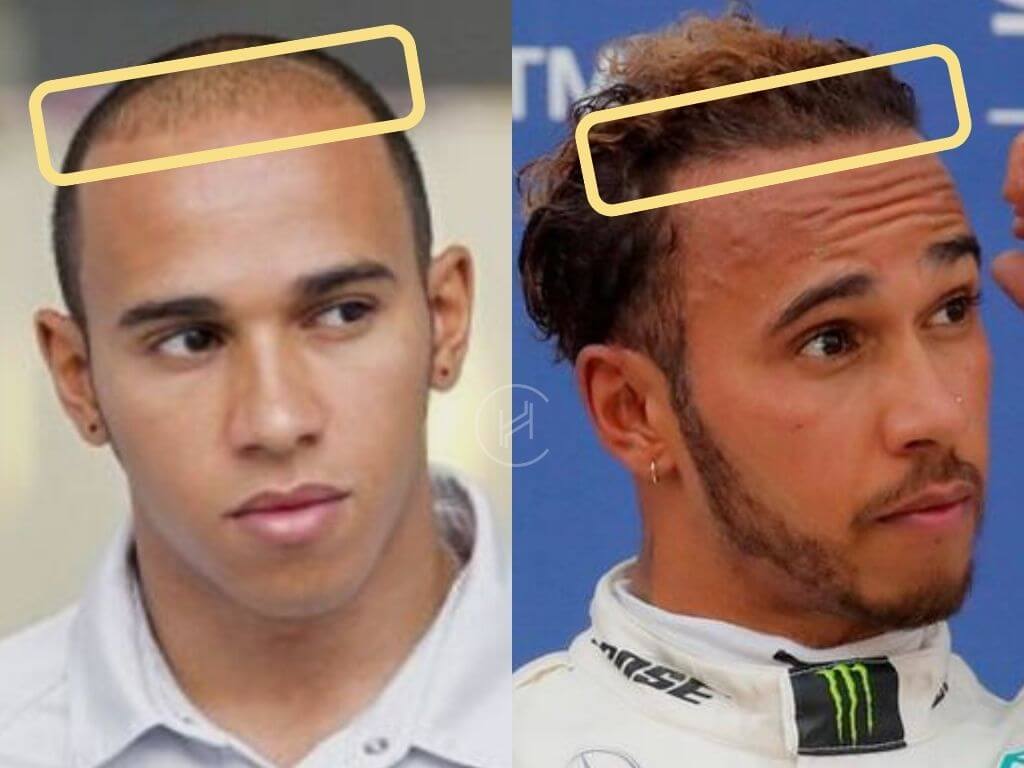 Lewis Hamilton Hair Transplant - Clinic Mono