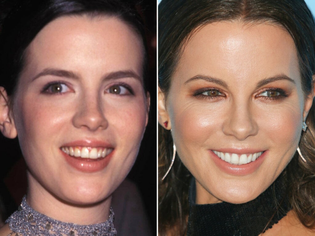 Kate Beckinsale Plastic Surgery - Clinic Mono
