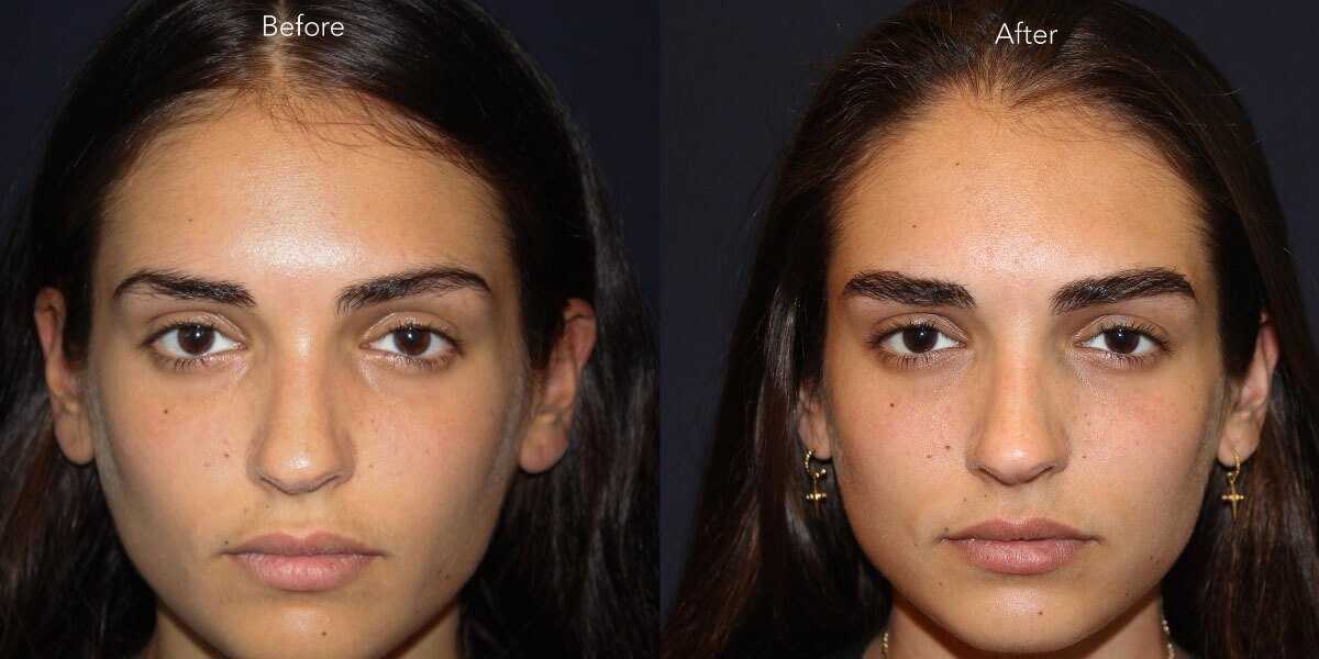 Eyebrow Transplant in Turkey - Clinic Mono