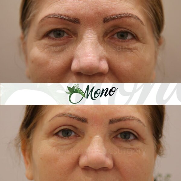 Eyelid Surgery Turkey Cost | Blepharoplasty | Eye Bag Removal Prices