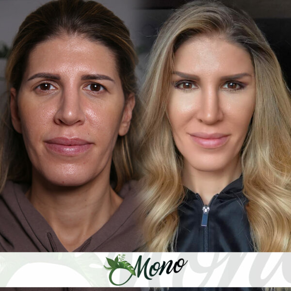 Fox Eye Lift in Clinic Mono in 2025