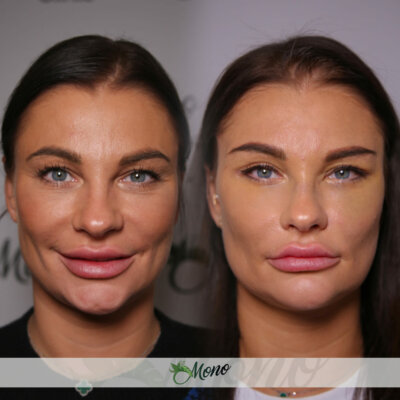 Fox Eye Lift in Clinic Mono in 2026