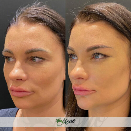 Fox Eye Lift in Clinic Mono in 2026