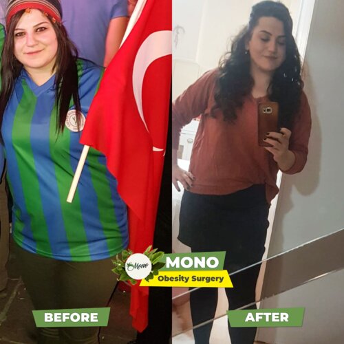 Gastric Botox in Turkey | Stomach Botox Injection Prices