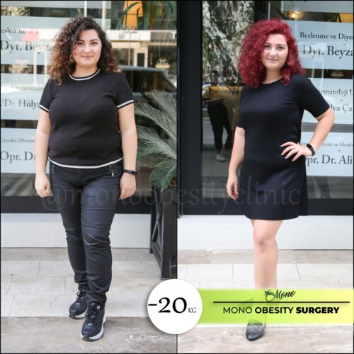 Gastric Botox in Turkey | Stomach Botox Injection Prices