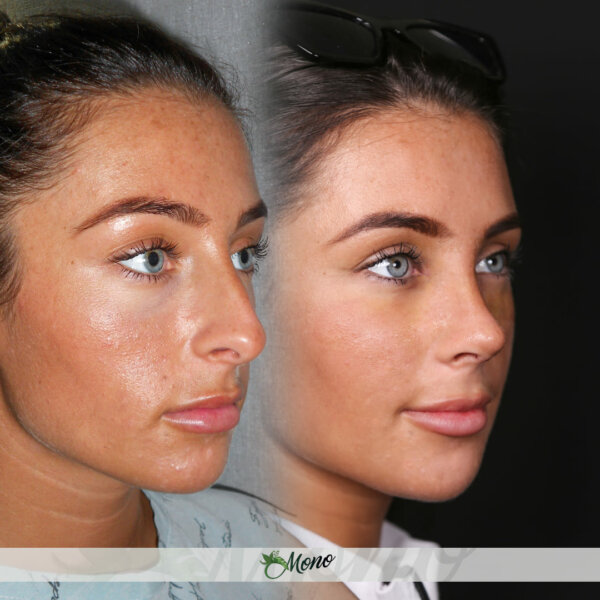 Rhinoplasty Turkey Nose Job | Nose Surgery Cost