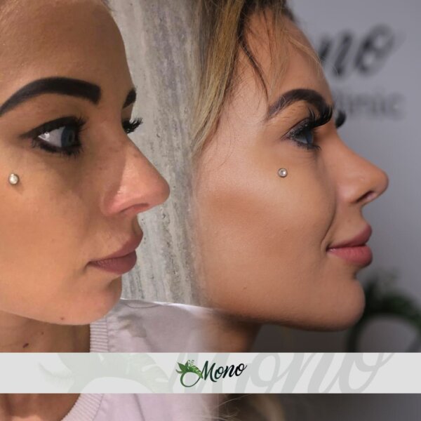 Rhinoplasty Turkey Nose Job | Nose Surgery Cost